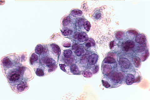 Chirurgie de la carcinose péritonéale Saint-Étienne - Centre de ...